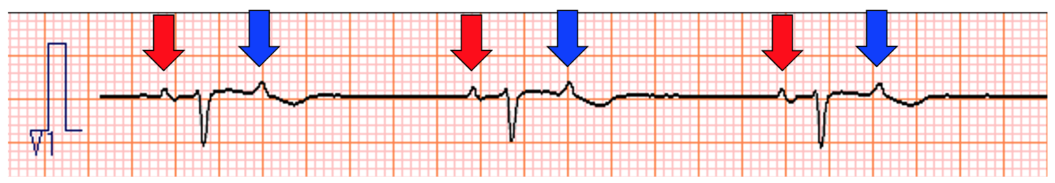 似ている心電図 002 洞性徐脈 vs blocked SVPCの二段脈 vs 2:1 AVB 心電図も筋トレもやり込め